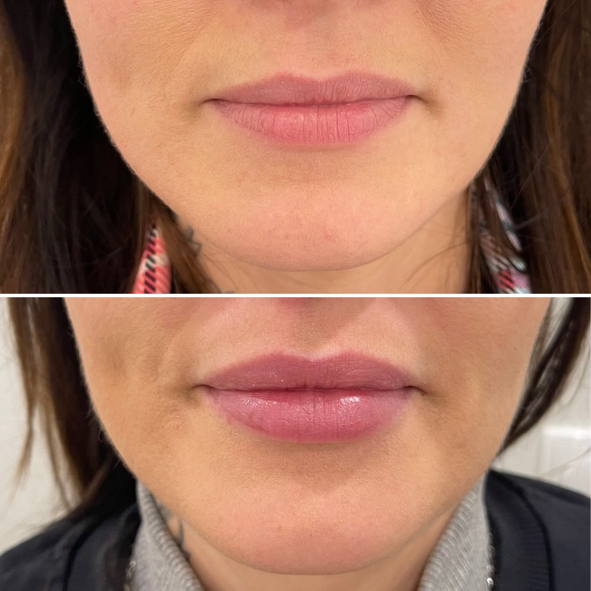 Czym się różni botoks od kwasu hialuronowego?